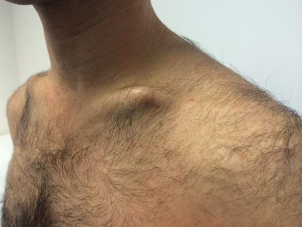 Ossos De Clavicula Reais Fratura Da Clavícula: Saiba Tudo Sobre A