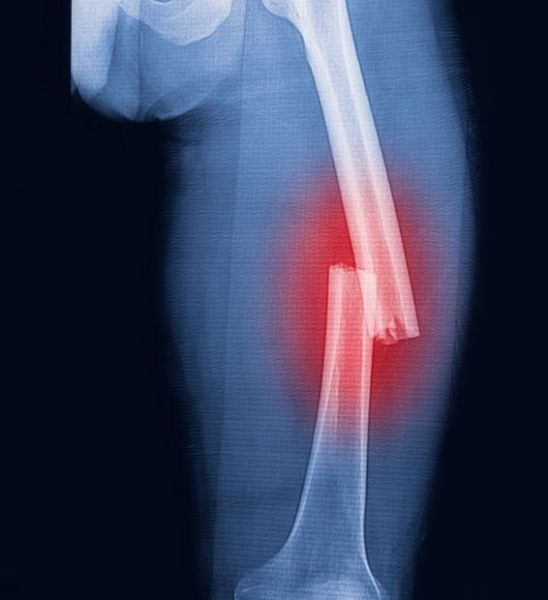 Dr. Diego Ariel - Fratura do Fêmur